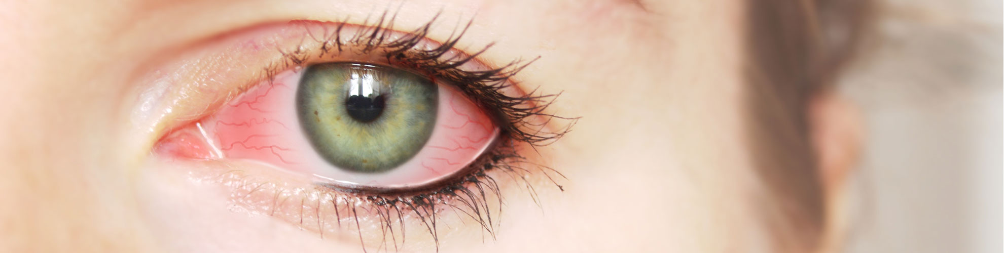Conjunctivitis - Mercer Island Family Eye Care